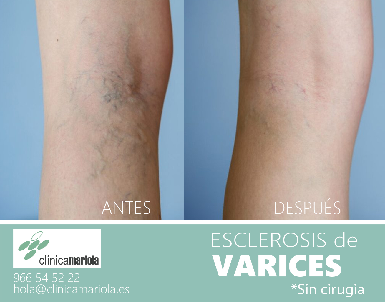 ESCLEROSIS de VARICES sin CIRUGÍA en Alcoy – Dra. Eugenia Gómez ...